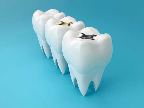 An Overview Of Tooth Fillings - Ballarat Dentist